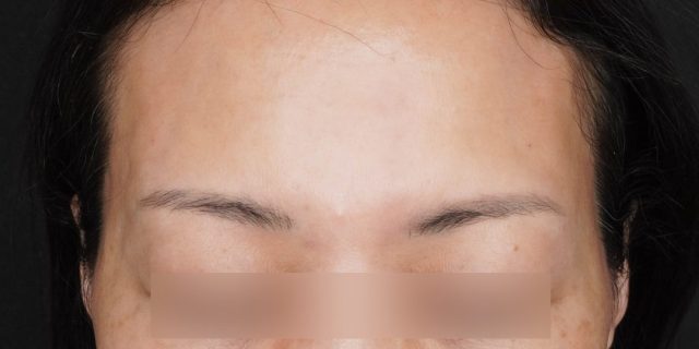 額・こめかみ | 一宮美容クリニック