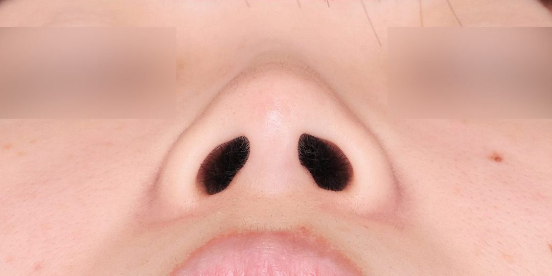 鼻 | 一宮美容クリニック